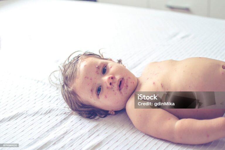 La Rubéole : Comprendre, Prévenir et Protéger - preegnancy.com